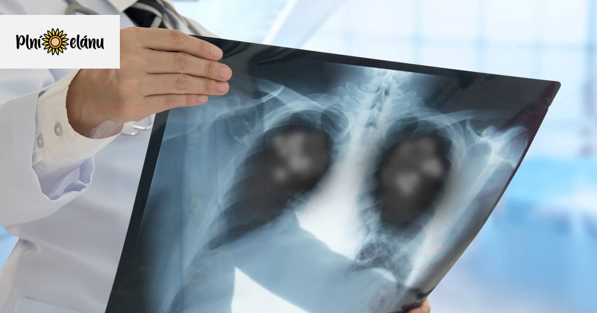 Rakovina pľúc postihuje aj nefajčiarov: Čo bije na poplach? - Plnielanu.sk
